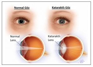 Katarakt Tedavisi Fiyatları 2025 | Prof. Dr. Gökhan GÜLKILIK